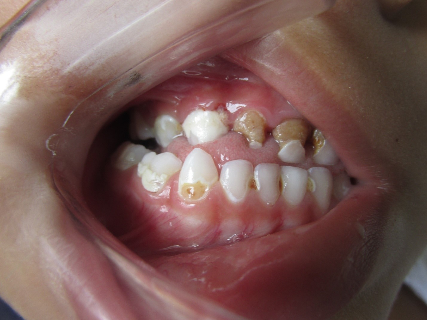 Tooth Decay In Children The Unanswered Truth Medchrome Tooth Decay In Children The Unanswered Truth Medchrome